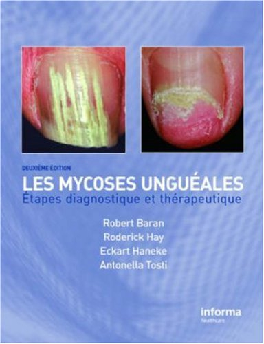 Onychomycosis/les mycoses ungueales: etapes diagnostique et clinique de ...